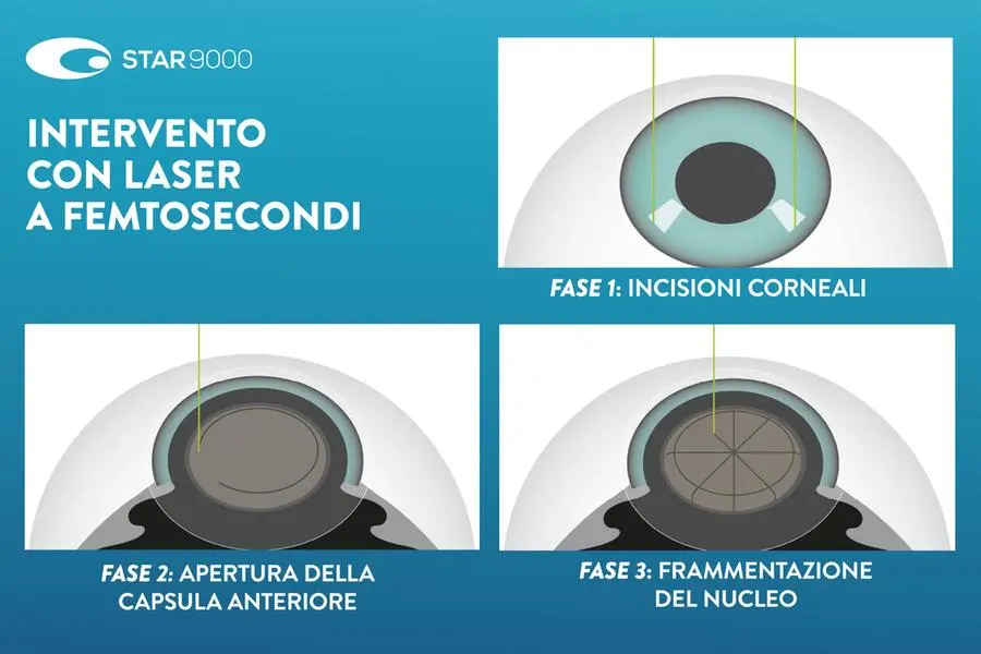 Cataratta: Chirurgia LASER senza bisturi | Giornale di Brescia